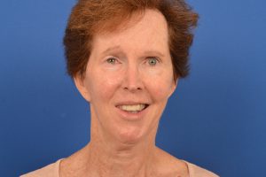 Facial Paralysis Before & After Photo Gallery | Dr. Azizzadeh