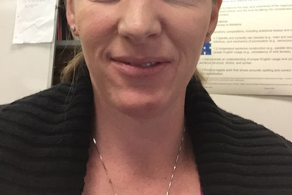 Facial Paralysis Before & After Photo Gallery | Dr. Azizzadeh