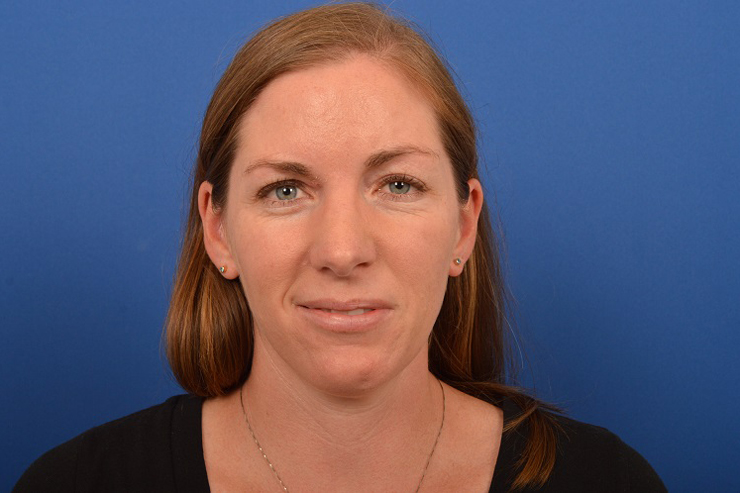 Facial Paralysis Before & After Photo Gallery | Dr. Azizzadeh