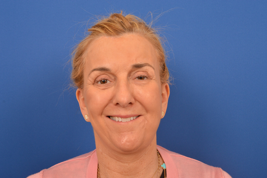 Facial Paralysis Before & After Photo Gallery | Dr. Azizzadeh