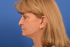 Facial Paralysis Before & After Photo Gallery | Dr. Azizzadeh