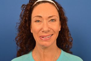 Facial Paralysis Before & After Photo Gallery | Dr. Azizzadeh