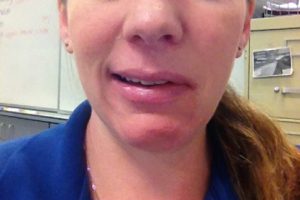 Facial Paralysis Before & After Photo Gallery | Dr. Azizzadeh