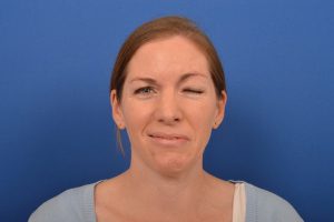 Facial Paralysis Before & After Photo Gallery | Dr. Azizzadeh
