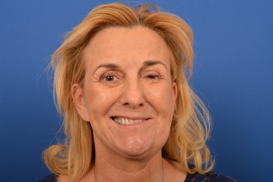 Facial Paralysis Before & After Photo Gallery | Dr. Azizzadeh