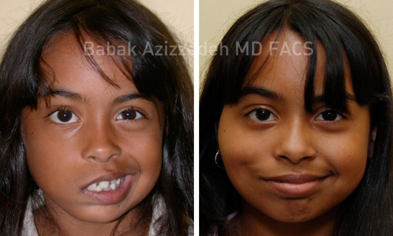 Gracilis Muscle Flap - Free Gracilis Muscle Transfer For Facial Paralysis