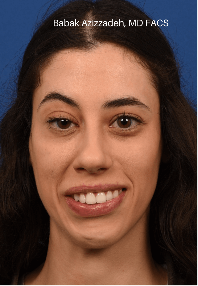 Bell's Palsy Before & After - Facial Paralysis Photo Gallery | FPI
