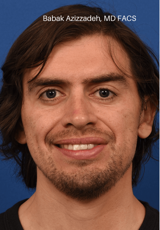 Bell's Palsy Before & After - Facial Paralysis Photo Gallery | FPI